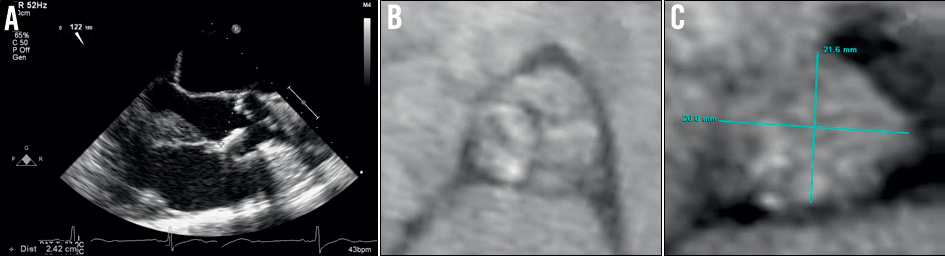 How should I treat acute aortic annulus rupture during transcatheter ...