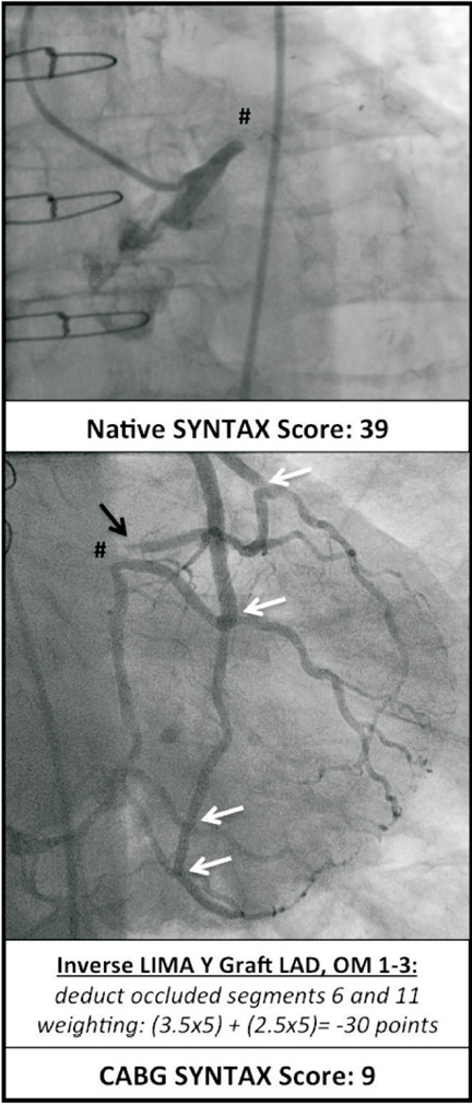 The CABG SYNTAX Score - an angiographic tool to grade the complexity of ...