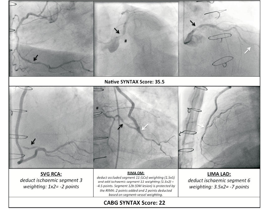 The CABG SYNTAX Score - an angiographic tool to grade the complexity of ...