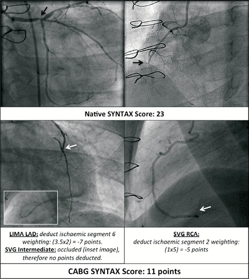 The CABG SYNTAX Score - an angiographic tool to grade the complexity of ...