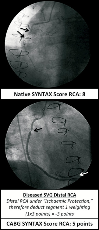 The CABG SYNTAX Score - an angiographic tool to grade the complexity of ...