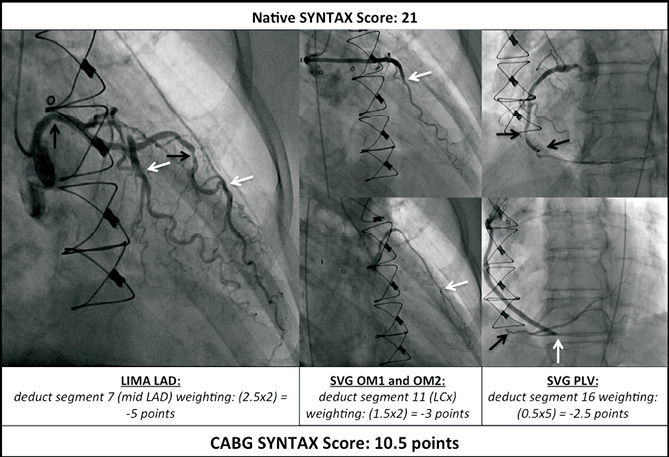 The CABG SYNTAX Score - an angiographic tool to grade the complexity of ...