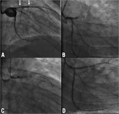 Stuck rotablator: the nightmare of rotational atherectomy ...