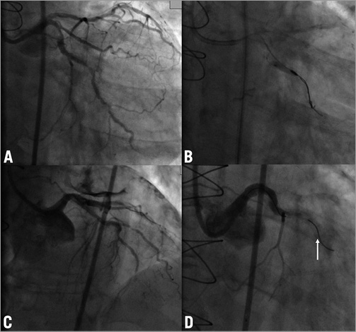 Stuck rotablator: the nightmare of rotational atherectomy ...