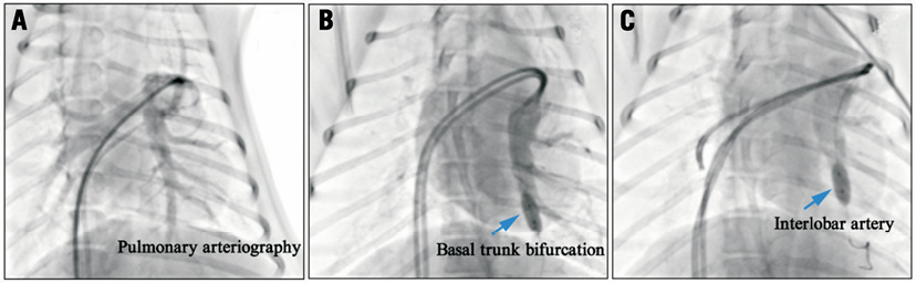 Percutaneous pulmonary artery denervation completely abolishes ...