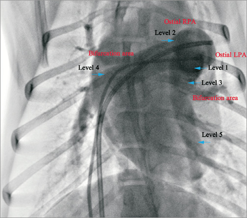 Percutaneous pulmonary artery denervation completely abolishes ...