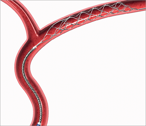 First-in-man intracoronary use of the Trevo® Pro 4 mechanical ...