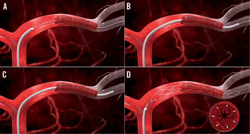 First-in-man intracoronary use of the Trevo® Pro 4 mechanical ...