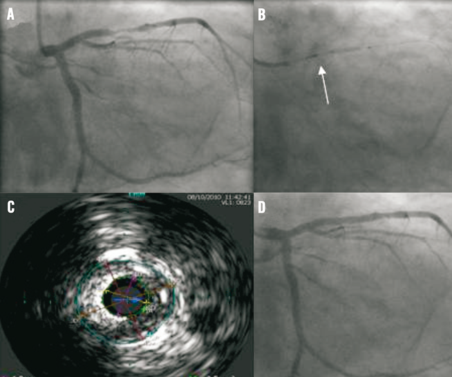 First-in-human experience using the Volcano VIBE-RX vascular imaging ...