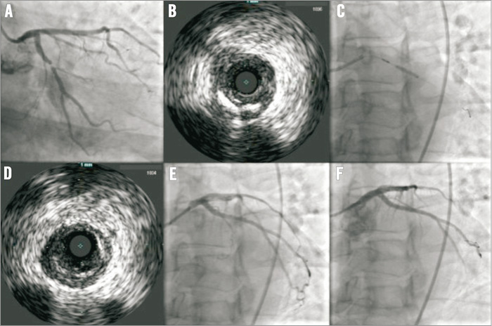 First-in-human experience using the Volcano VIBE-RX vascular imaging ...
