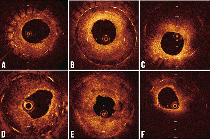 Appearance of neointima according to stent type and restenotic phase ...