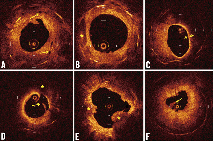 Appearance of neointima according to stent type and restenotic phase ...