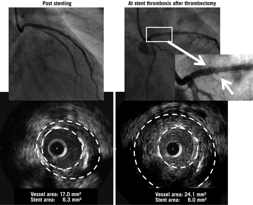 Peri-stent contrast staining and very late stent thrombosis after ...