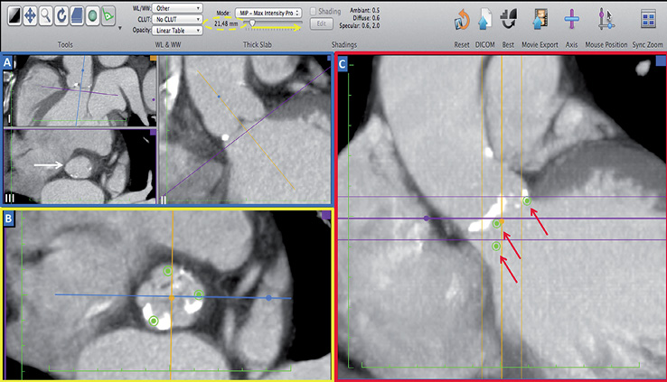 Pre-defining optimal C-arm position for TAVI with CT-scan using free ...