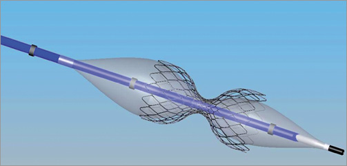 Transcatheter treatment for refractory angina with the coronary sinus ...