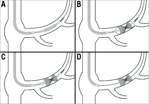 Transcatheter treatment for refractory angina with the coronary sinus ...