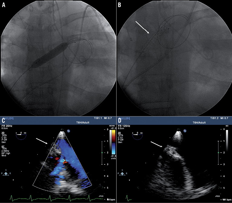 First-in-man experience with cryoplasty during graded balloon atrial ...