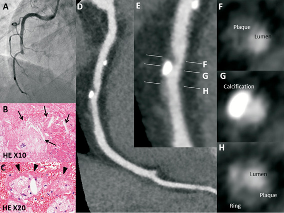 Signet ring-like appearance: specific feature of vulnerable plaques ...