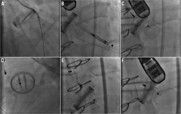 Tools and Techniques - Clinical: Paravalvular leak closure ...