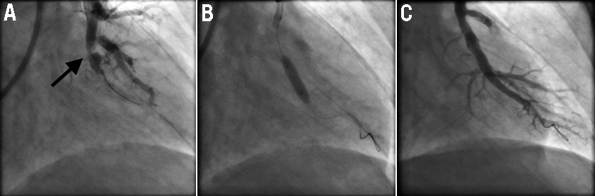 Efficacy of 360-degree three-dimensional rotational pulmonary ...