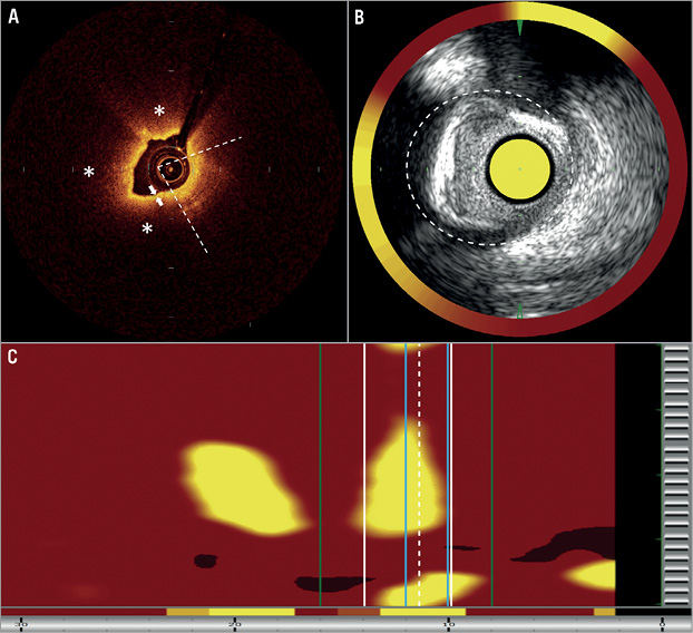 Combined NIRS and IVUS imaging detects vulnerable plaque using a single ...