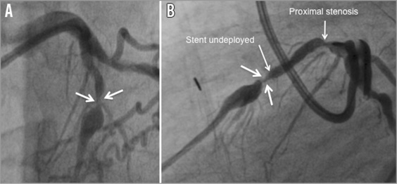 How should I treat an undeployed stent stuck in the proximal LAD? Going ...