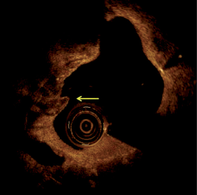 High definition OCT image of sharp calcium spicule - EuroIntervention