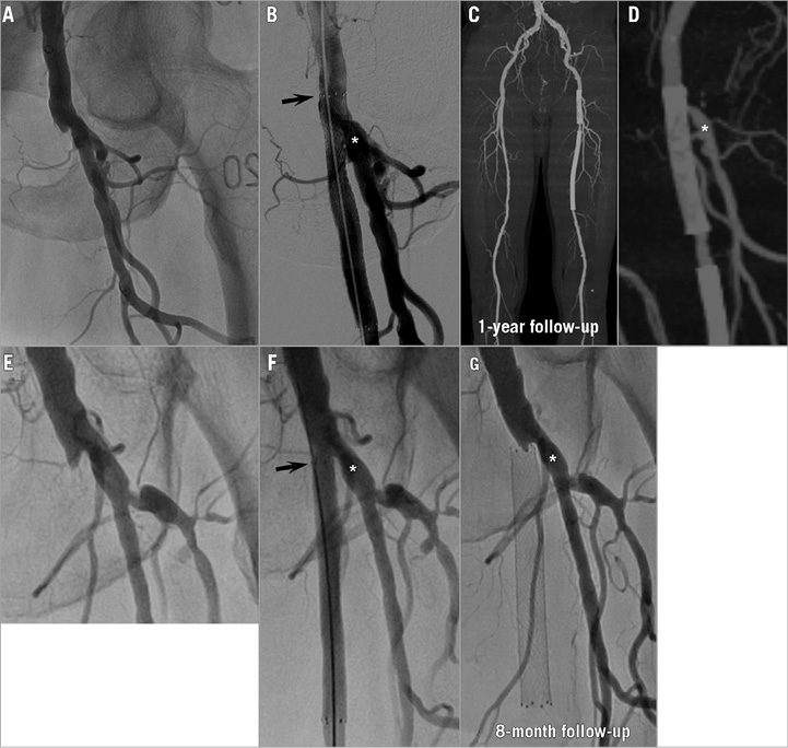 Outcomes of stents covering the deep femoral artery origin ...