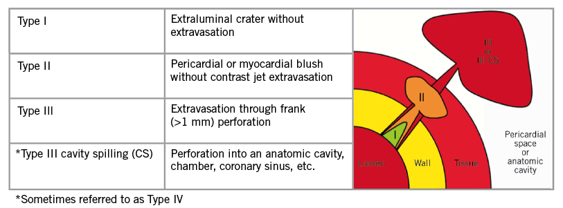 Tools & Techniques - Clinical: Management of coronary perforation ...