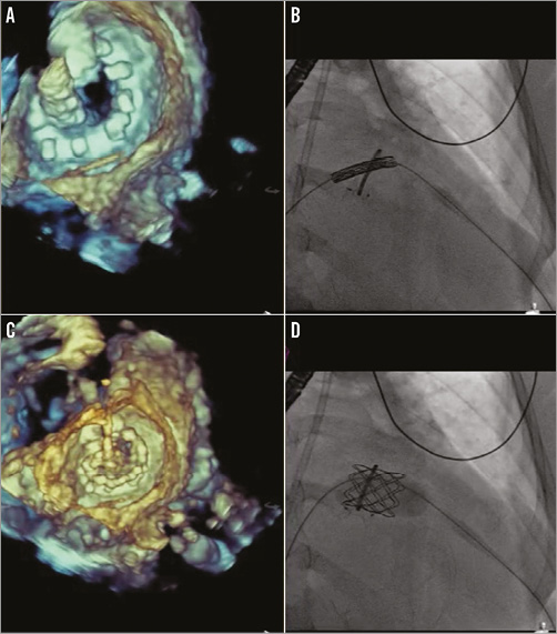 Successful first-in-man percutaneous transapical-transseptal Melody ...