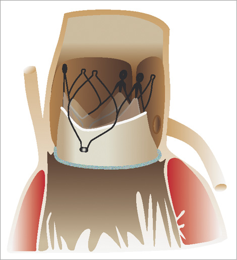 The challenge of valve-in-valve procedures in degenerated Mitroflow ...