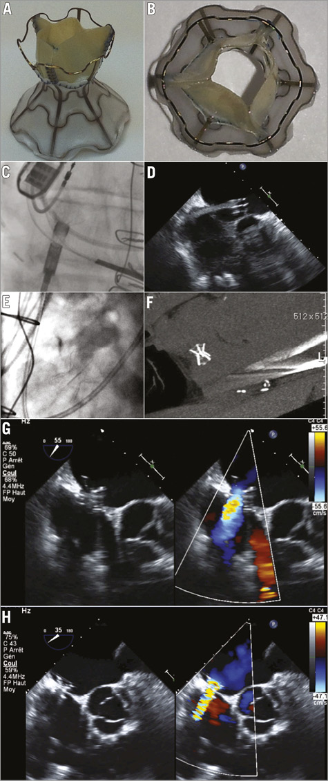 Left atrial decompression through unidirectional left-to-right ...