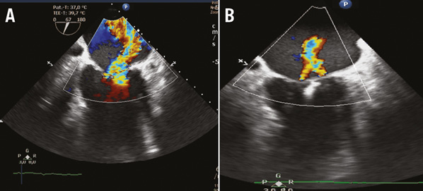 “First-in-man” MitraClip via pulmonary vein access through a right mini ...