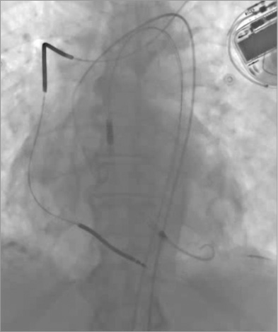 Tools & Techniques - Clinical: Percutaneous catheter-based left ...