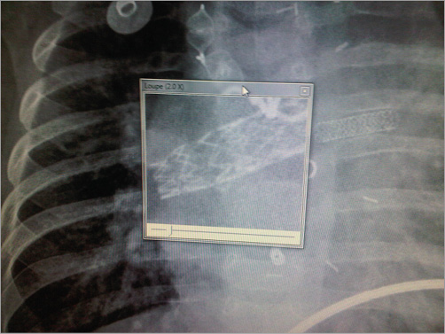 The VALEO® vascular stent for cardiovascular lesions in children ...