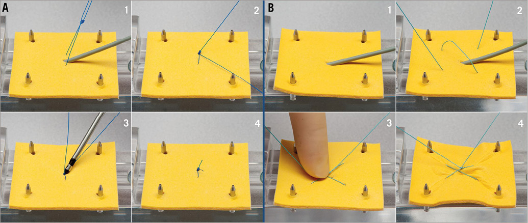 Feasibility and clinical benefit of a suture-mediated closure device ...