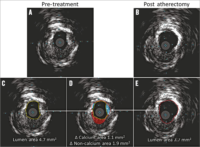 Intravascular ultrasound evaluation of JETSTREAM atherectomy removal of ...