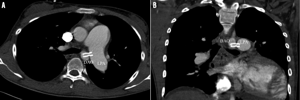 Transcatheter creation of a reverse Potts shunt in a patient with ...