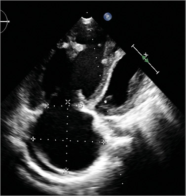 Transcatheter creation of a reverse Potts shunt in a patient with ...