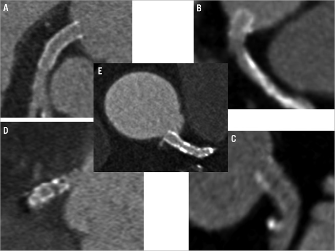 Geographic miss with aorto-ostial coronary stent implantation: insights ...