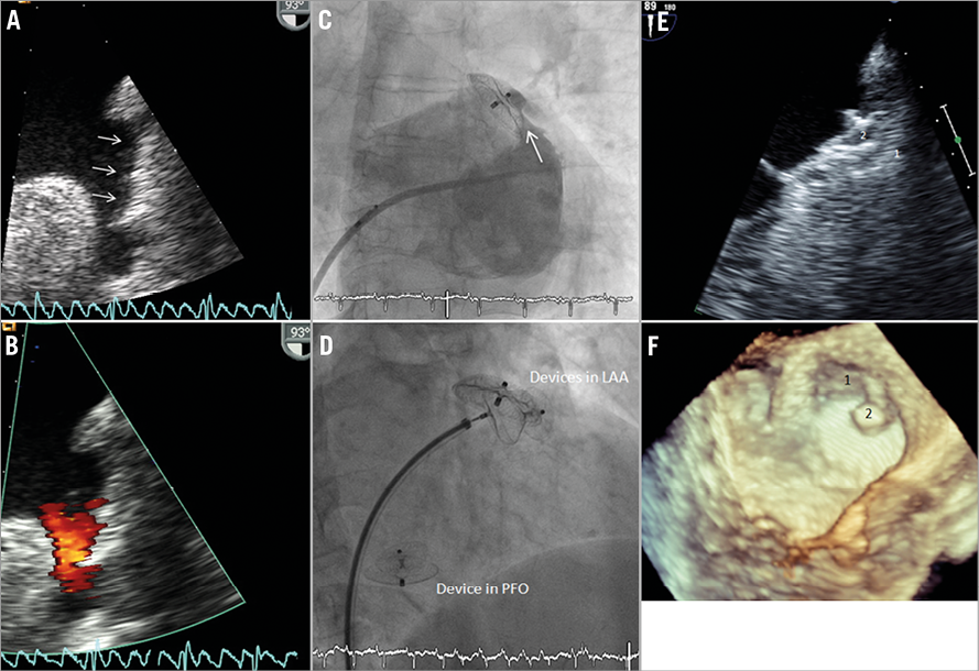 Double device left atrial appendage closure - EuroIntervention