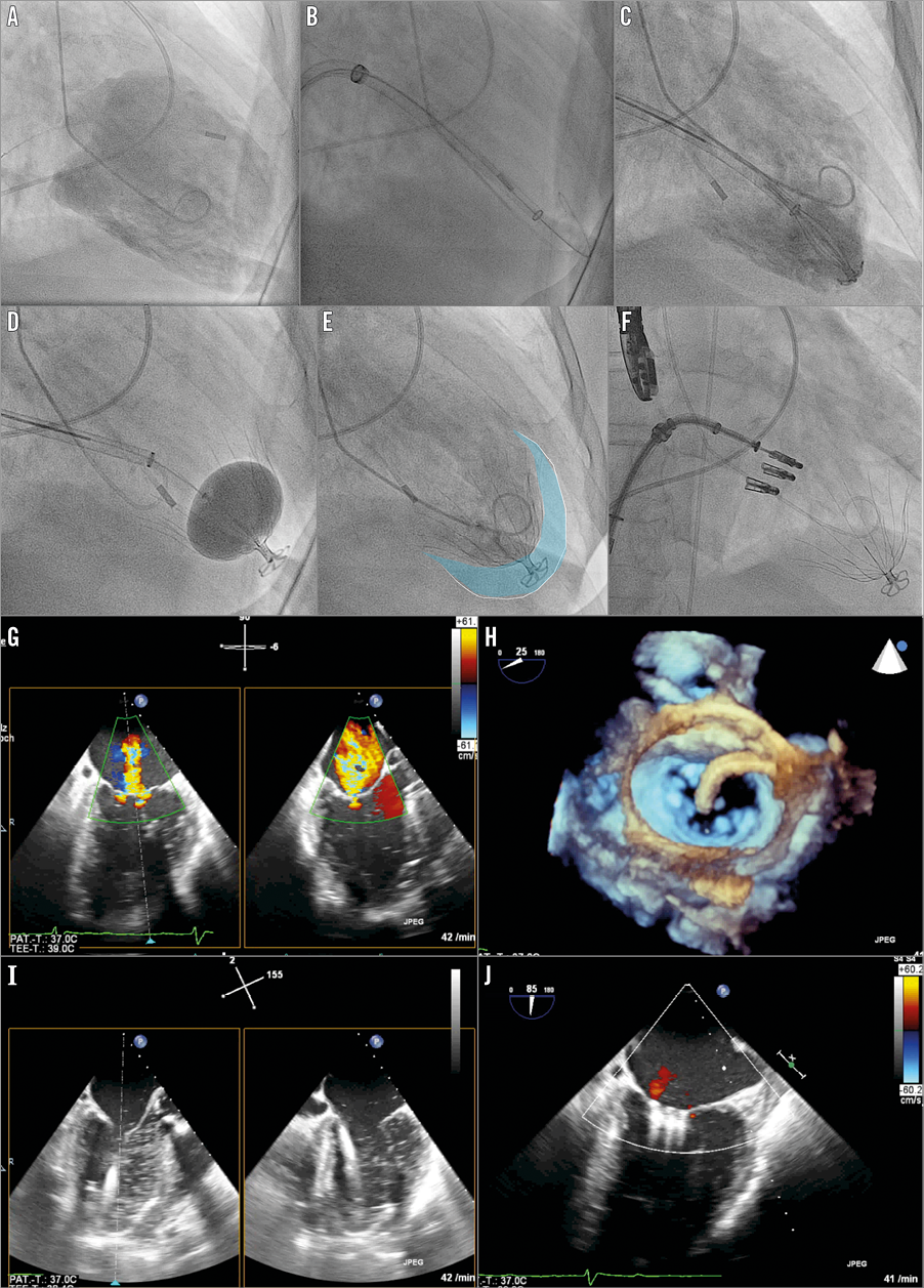 Transseptal and transmitral Parachute® implantation in conjunction with ...
