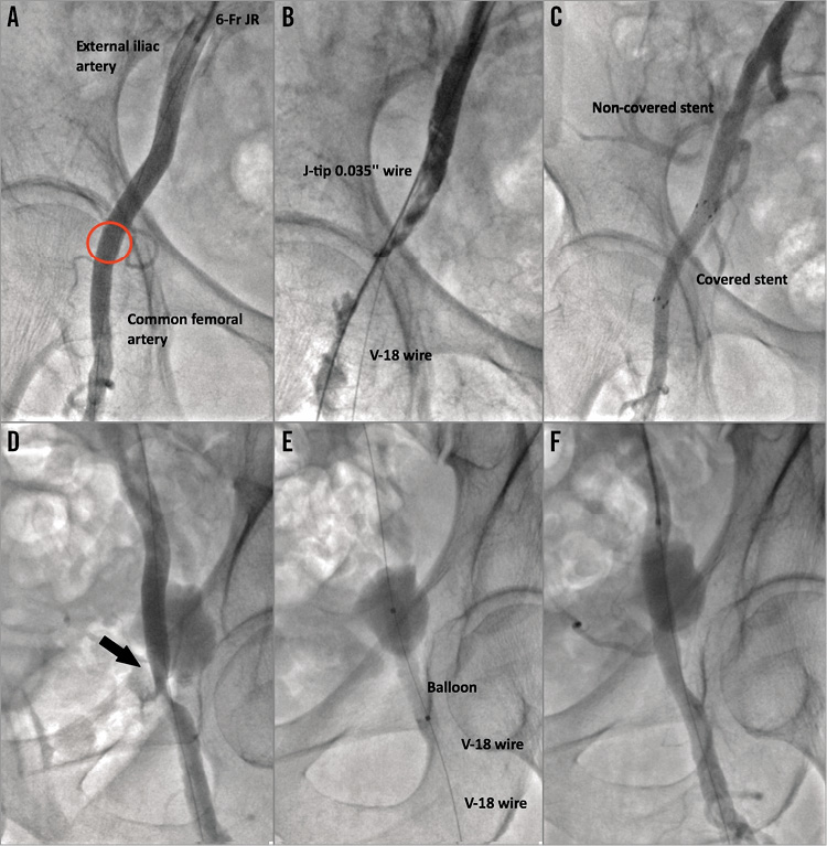 Comparison of suture-based vascular closure devices in transfemoral ...