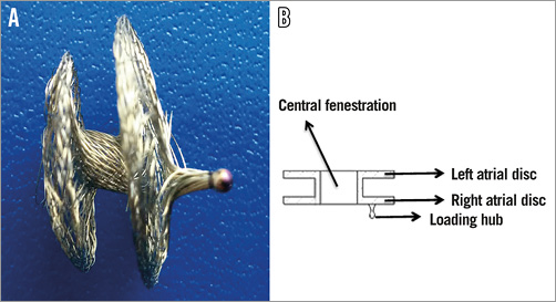 Implantable atrial flow regulator for severe, irreversible pulmonary ...