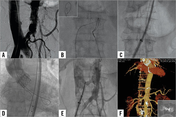 First use of an expandable sheath and transcaval access for ...
