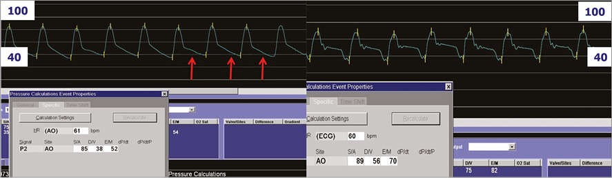 The PulseCath iVAC 2L left ventricular assist device: conversion to a ...