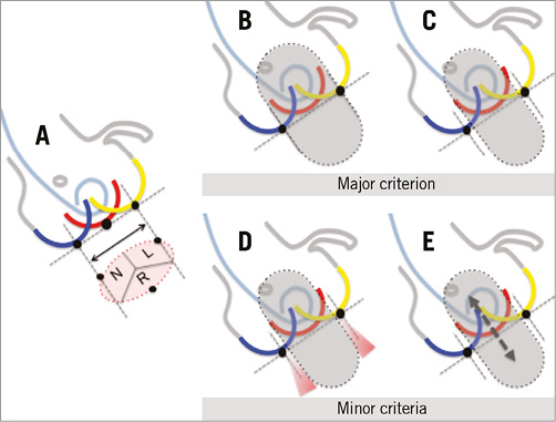 Tools and Techniques - Clinical: Fluoroscopic balloon sizing of the ...