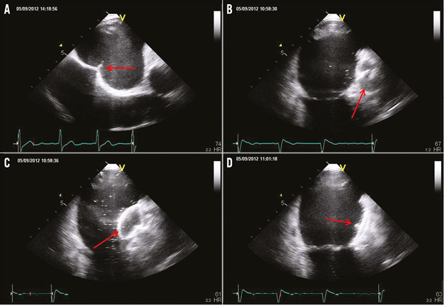 Left atrial appendage closure monitoring without sedation: a pilot ...
