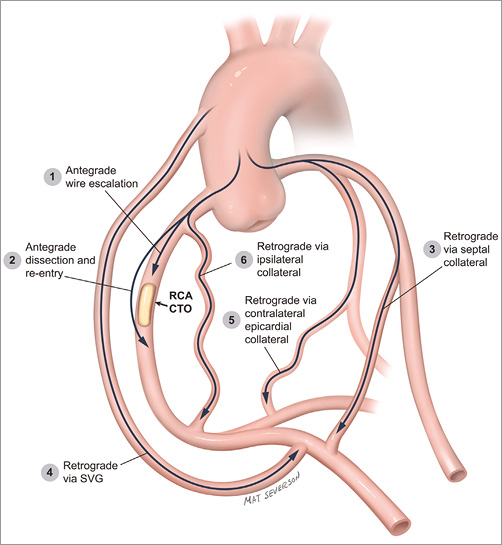 Expanding options for retrograde recanalisation of right coronary artery chronic total ...