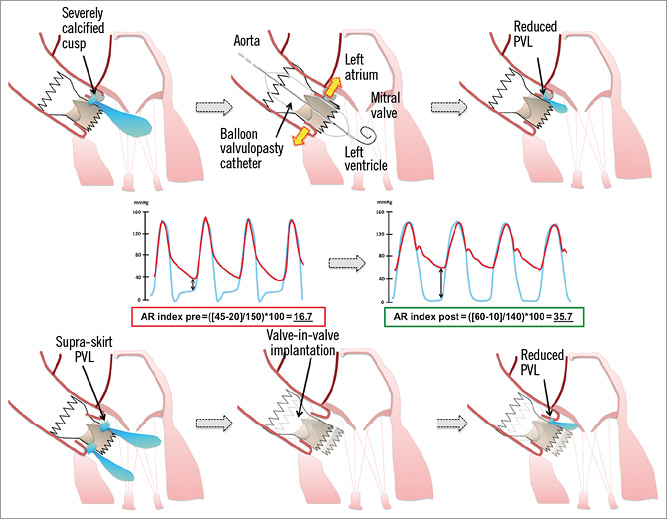 Balloon post-dilation and valve-in-valve implantation for the reduction ...